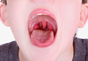 Cirugía de amígdalas (anginas) - Rinoplastia en Monterrey